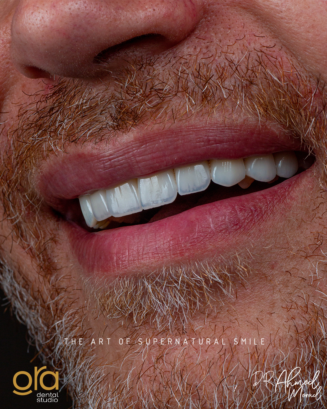 فينير الأسنان - Ora Dental Studios